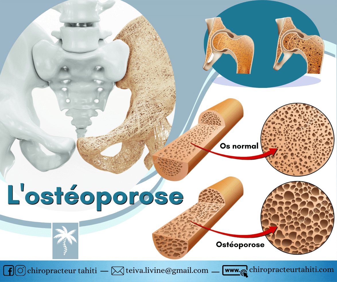 Quelle Est La Différence Entre Une Osteopénie Et Une Ostéoporose – MFTZTR